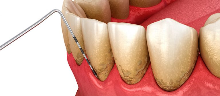 Solución para las Bolsas Periodontales | Dentista Huesca